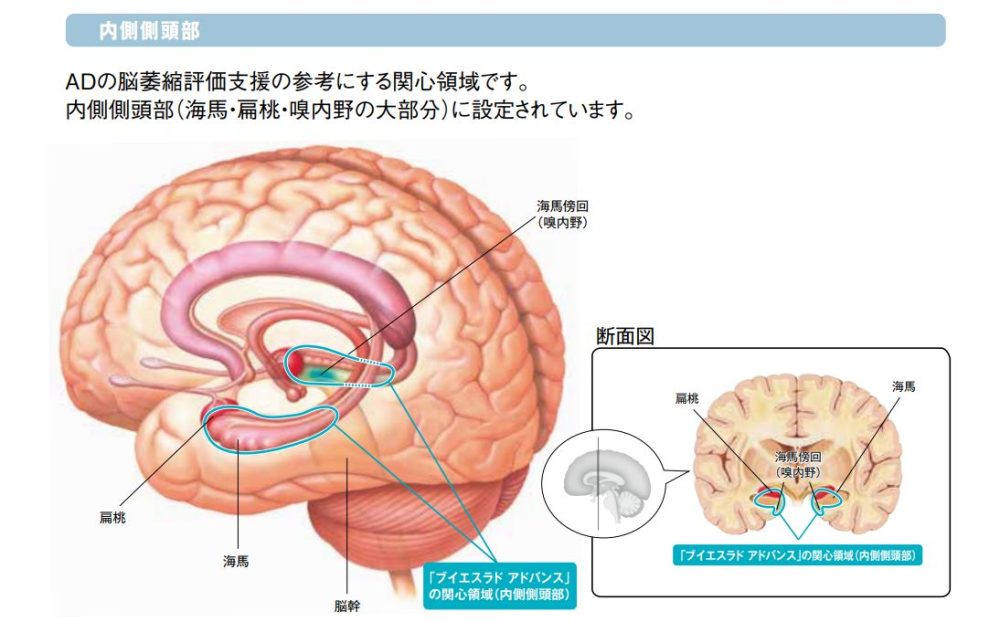 脳の萎縮を診る検査 【VSRAD】 （認知症検査） | 脳神経外科・脳神経内科・リハビリテーション科 あづま脳神経外科リハビリクリニック